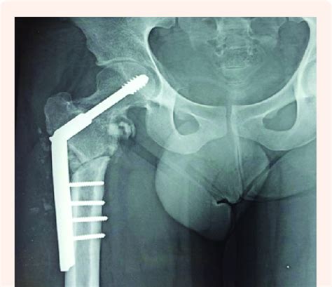 Post Operative Radiograph At Year Of Follow Up Download Scientific Diagram