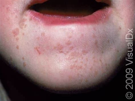 Hpv Bumps Around Mouth