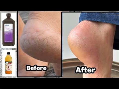 Hydrogen Peroxide Foot Soak Recipe Xbvya
