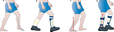 Cerebral Palsy Pmc