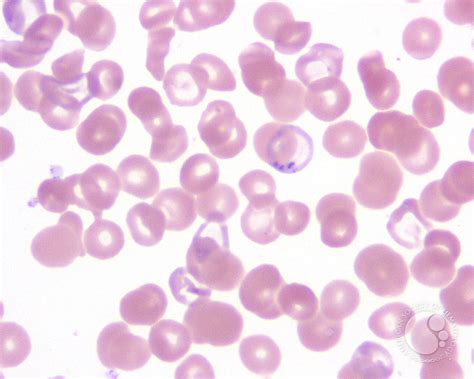 Basophilic Stippling Lead Poisoning 4