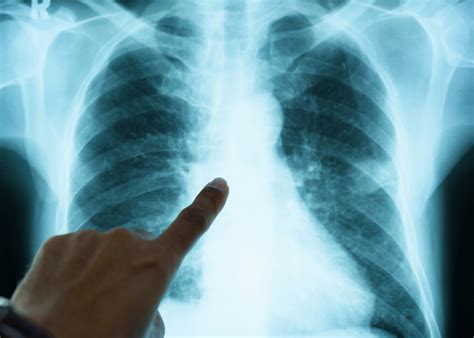 Scleroderma All You Need To Know About This Autoimmune Disease