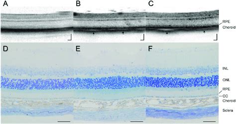 Choroidal Thickening Associated With Dilated Choroidal Vessels After
