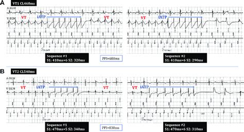 Case 1 Intracardiac Electrogram Egm Of Ventricular Tachycardia Vt Download Scientific