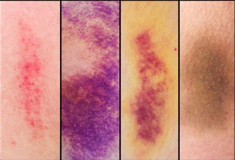 What Do The Colors In Bruises Mean Shelia Huxtable
