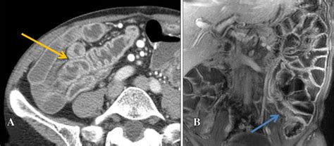 A Axial Cte Showing Findings Of Ulcerative Jejunitis In A Type Ii Rcd