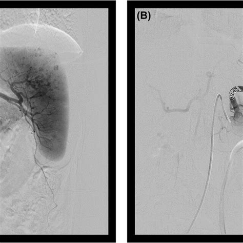 Embolization Of The Spleen A Pre And B Post Coil Placement Download Scientific Diagram