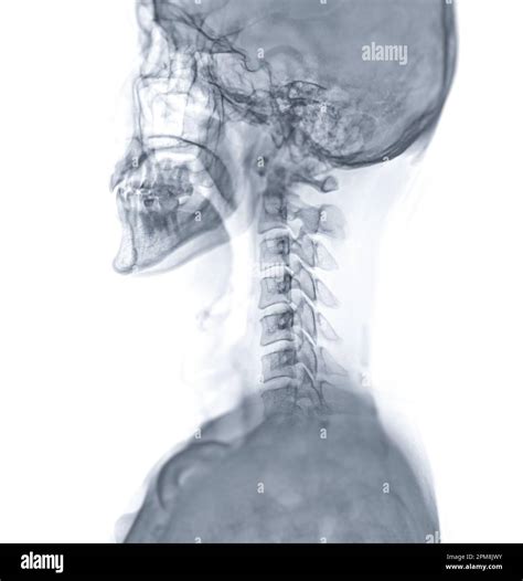 X Ray C Spine Or X Ray Image Of Cervical Spine Lateral View For Diagnostic Intervertebral Disc