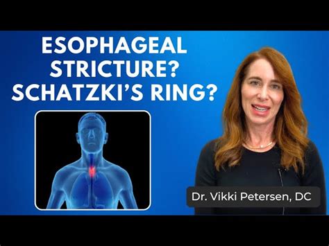 Esophageal Stricture Schatzkis Ring Heres What To Do Video