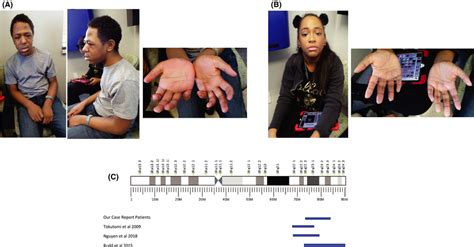 A Photographs Of Patient 1 Showing Dysmorphic Facial Features And 5th