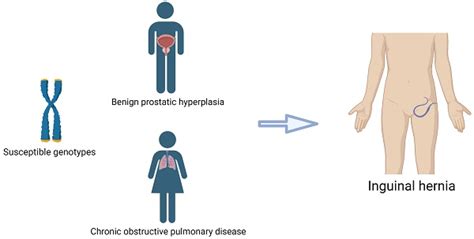 E785 Icd Sex Specific Genetic Variants Associated With Adult Onset