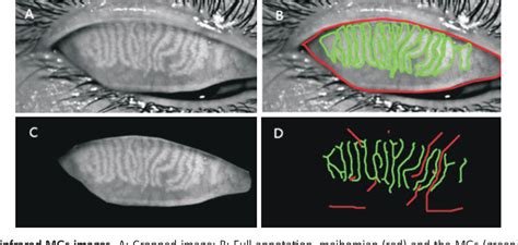 Figure 1 From Meibomian Glands Segmentation In Infrared Images With