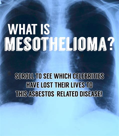 Celebrities Bringing Awareness To Asbestos Disease • A Tech Consulting