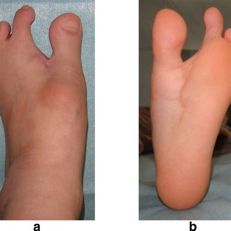 Blauth And Borisch Classification Of Cleft Foot Download Scientific