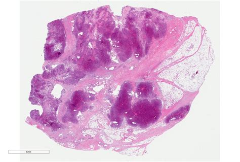 Pathology Outlines Epithelioid Sarcoma