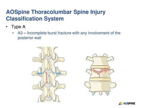 Classification And Management Of Thoracolumbar Fractures Ppt Download