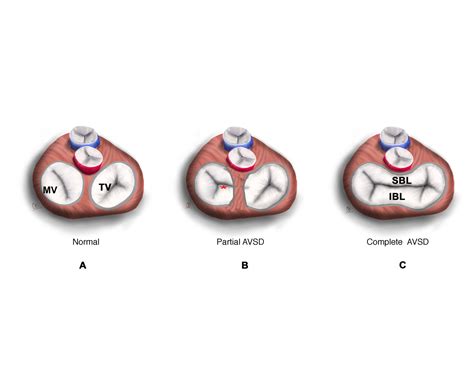 Part 2 Transesophageal Echocardiography In Congenital Mitral Valve Disease Congenital
