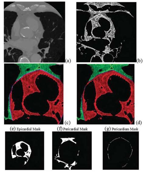 Figure 1 From Segmentation Of Cardiac Epicardial And Pericardial Fats By Using Gabor Filter Bank