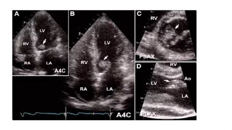 Infective Endocarditis Echocardiography Pptx