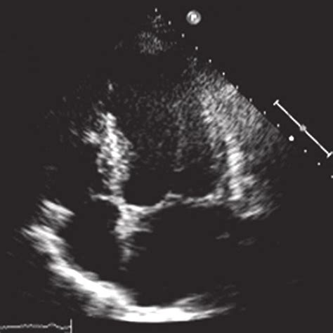 Two Dimensional Transthoracic Color Flow Doppler Echocardiogram Shows Download Scientific
