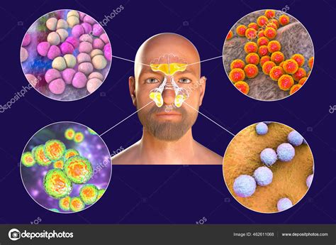 Rhinosinusitis Pada Manusia Dan Bakteri Yang Menyebabkan Sinusitis