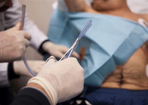 Needle Thoracostomy Vs Chest Tube All You Need To Know Hpc