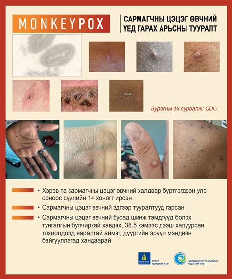 Сармагчны цэцэг Нийгмийн эрүүл мэндийн үндэсний төв