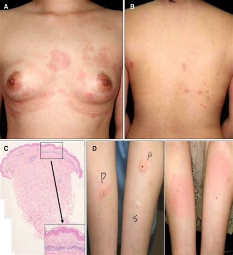 Autoimmune Progesterone Dermatitis Causes Symptoms Diagnosis And Treatment