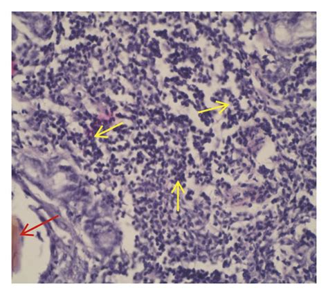 A Numerous Mononuclear Cells Yellow Arrows Mainly Macrophages