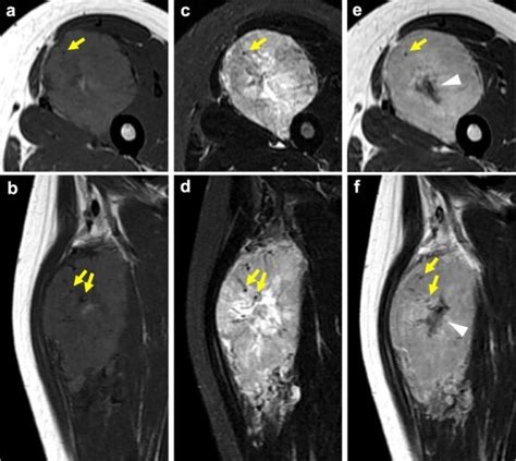 Advances In Treatment Of Alveolar Soft Part Sarcoma An Updated Review