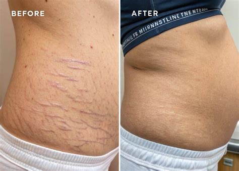 What Are The Benefits Of Rf Microneedling