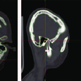 Condylar Axis Angle On Multiplanar Reconstruction Images Axial Download Scientific Diagram