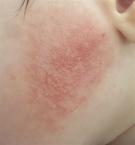 Antibiotic For Weeping Eczema At Ronald Pepper Blog