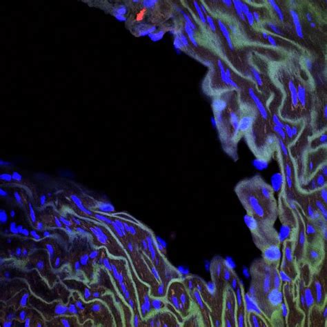 Progerias Cardiovascular Complications Could Be Treated With New Protein Finding