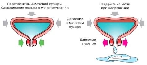Недержание мочи у женщин. По некоторым сведениям, каждая третья женщина ...