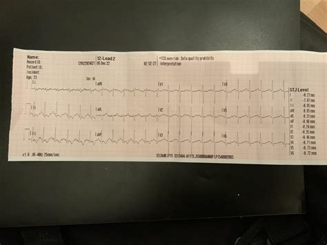 ambulance crew said i had a interesting ecg r askcardiology