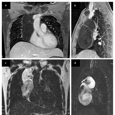 Computed Tomography A Small Nodule Was Found In The Lingular Segment Download Scientific Diagram