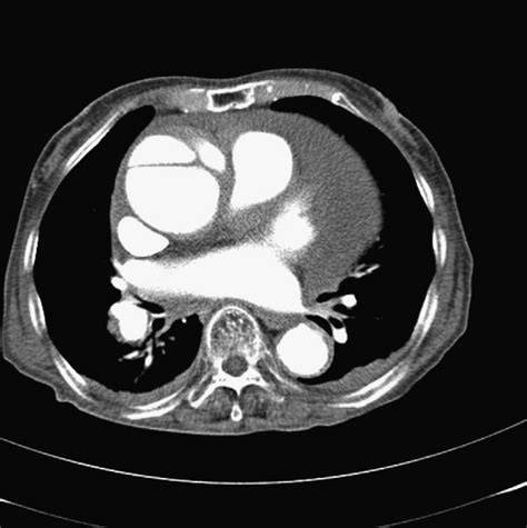 Type A Aortic Dissection A Massive Hemopericardium And A Small
