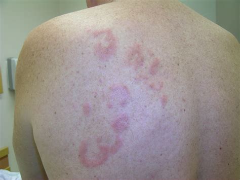 Follicular Lymphoma Rash