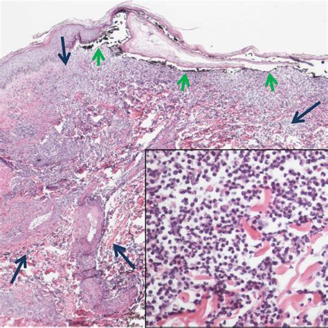 Pdf A Case Of Ulcerative Colitis Presenting As Pyoderma Gangrenosum And Lung Nodule