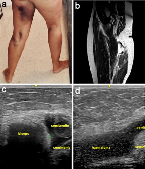 Pdf Reconstruction Of Chronic Proximal Hamstring Tear A Novel