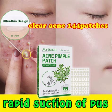 Pimple Spot Treatment Sticker Luxe Organix Pimple Patch Remove Pimples Patch Acne Patches 144pcs