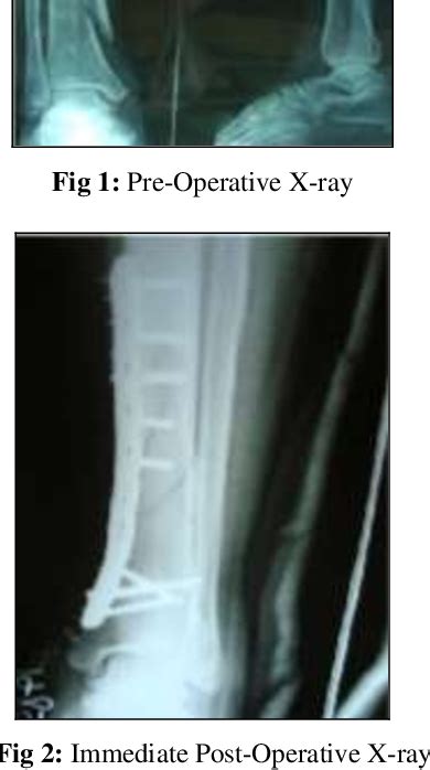 Figure 2 From Management Of Distal Tibia Fractures With Mippo Semantic Scholar