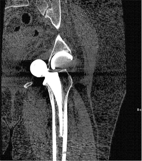 The Journal Of Bone And Joint Surgery Inc On Linkedin Obturator