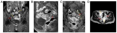 Preoperative Mri Findings A Preoperative Mri Indicated Two Enlarged