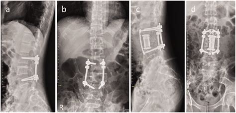 Postoperative Plain Radiographs After The Two Stage Surgery The Download Scientific Diagram