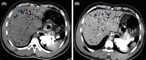 A Axial Noncontrast B Axial Postcontrast Ct Images Demonstrating