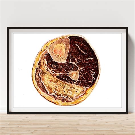 Muscle Degeneration Fibrosis And Fat Art Print By Wellcome Images