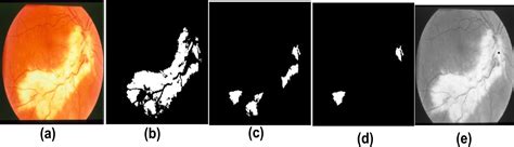 Figure 4 From Automatic Detection Of Exudates For Grading Of Macular Edema In Retinal Fundus