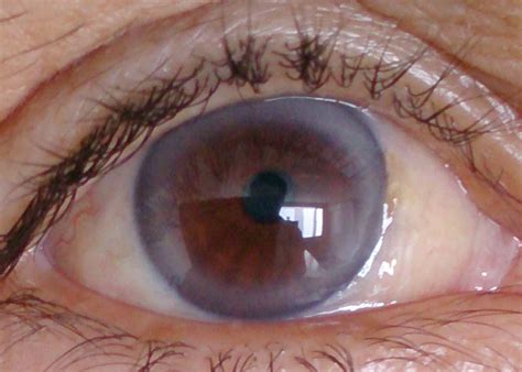 Arcus Senilis Of The Eyes Stock Image Science Source Images 57 Off